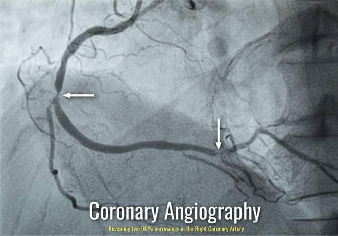 Coronary Angiography (CAG)